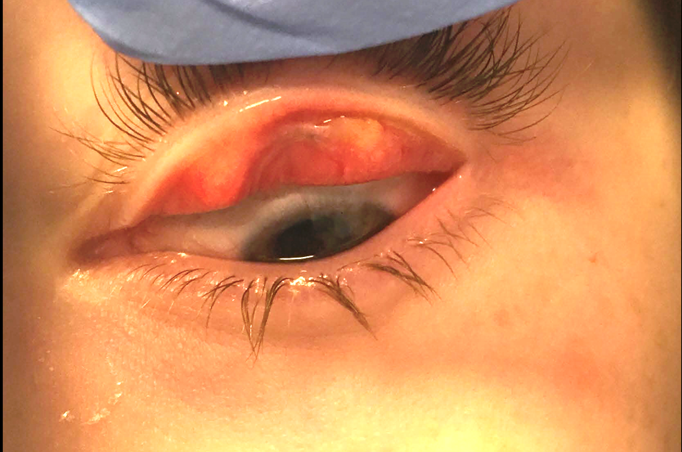 VisionGenius-Ophthalmology - Ligneous Conjunctivitis